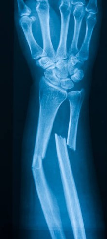 SEVERE IMPAIRMENT: What is it? How to Prove it?